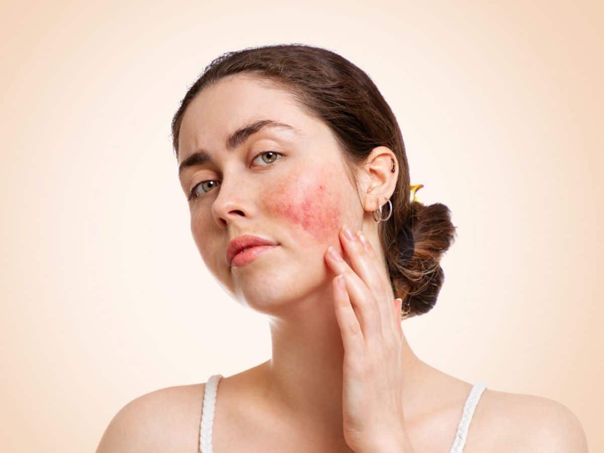 Rosacea Signs, Symptoms, and Treatments! - Bellaire Dermatology