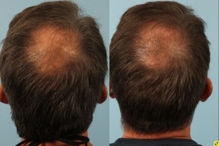 Restore Hair Growth with PRF Hair Restoration in Bellaire, TX ...